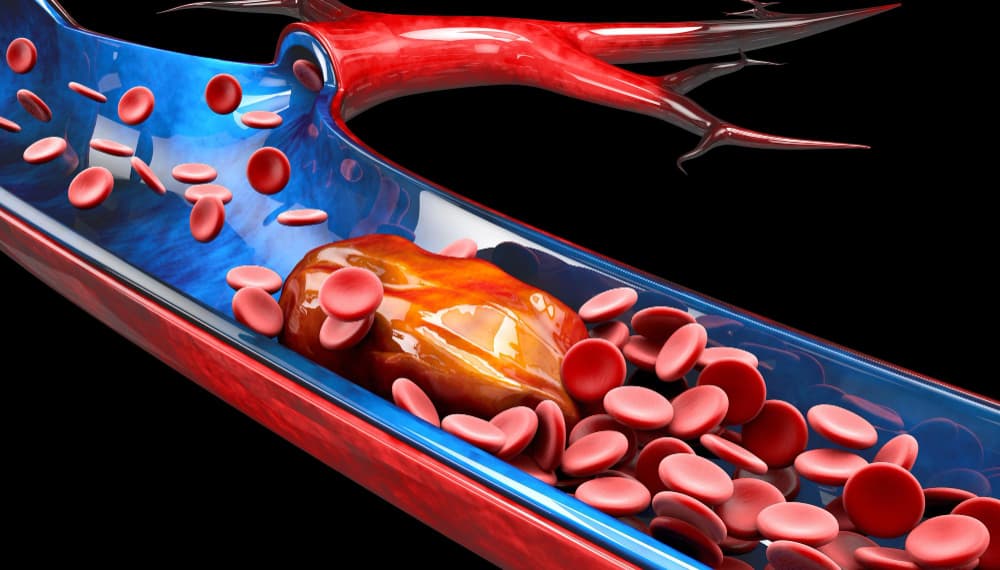 Deep Vein Thrombosis (DVT) Treatment | Medical Park