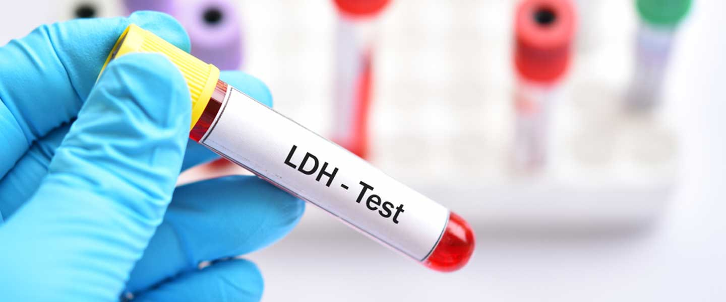 LDH nedir? LDH Düşüklüğü ve Yüksekliği Ne Anlama Gelir?