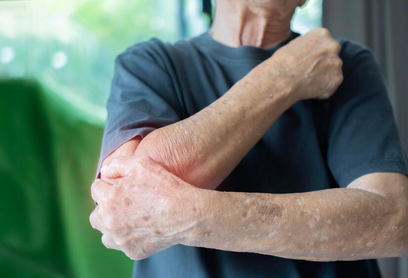 Bursit Eksizyonu Nedir? Bursit Eksizyonu Tedavisi