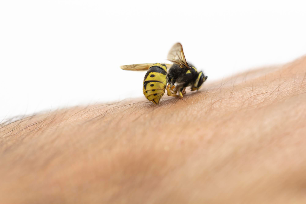 Bee Stings and Allergies: Symptoms and Treatment