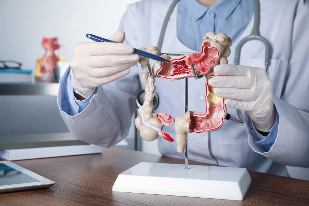 Colon Cancer: Symptoms, Causes, and Treatment