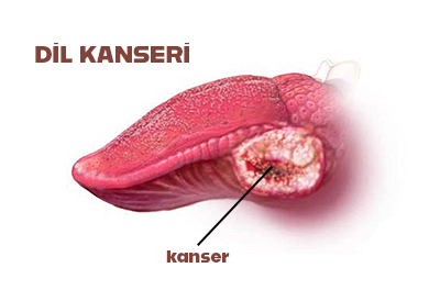 Dil Kanseri Nedir? Dil Kanseri Belirtileri Nelerdir?