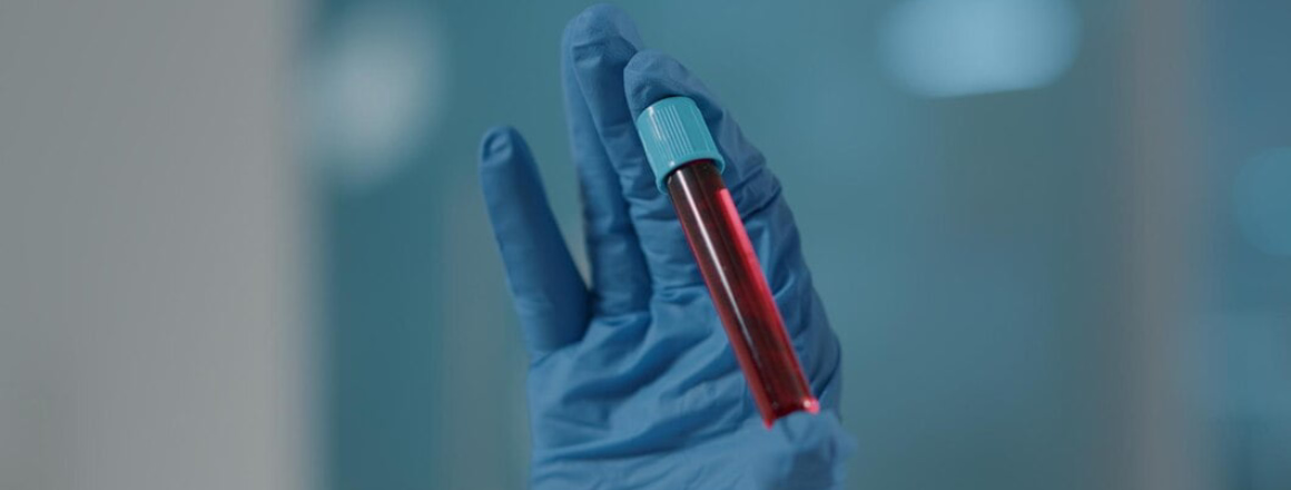 Lipaz Kan Tahlili Nedir? Lipaz Düşüklüğü, Yüksekliği