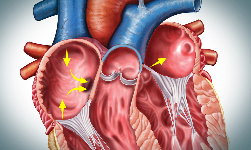 PFO (Patent Foramen Ovale) Nedir? PFO Belirtileri ve Tedavisi
