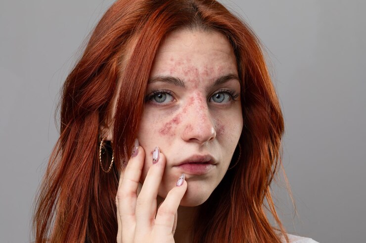 Pemfigus Vulgaris Nedir? Pemfigus Vulgaris Belirtileri ve Te