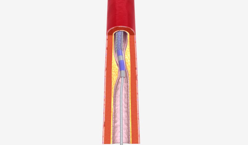 Stent Nedir? Stent Nasıl Takılır?