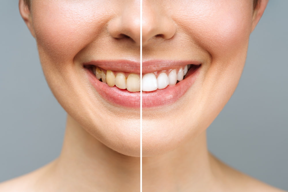 Teeth Whitening in Turkey: Procedure, & Cost | Medical Park