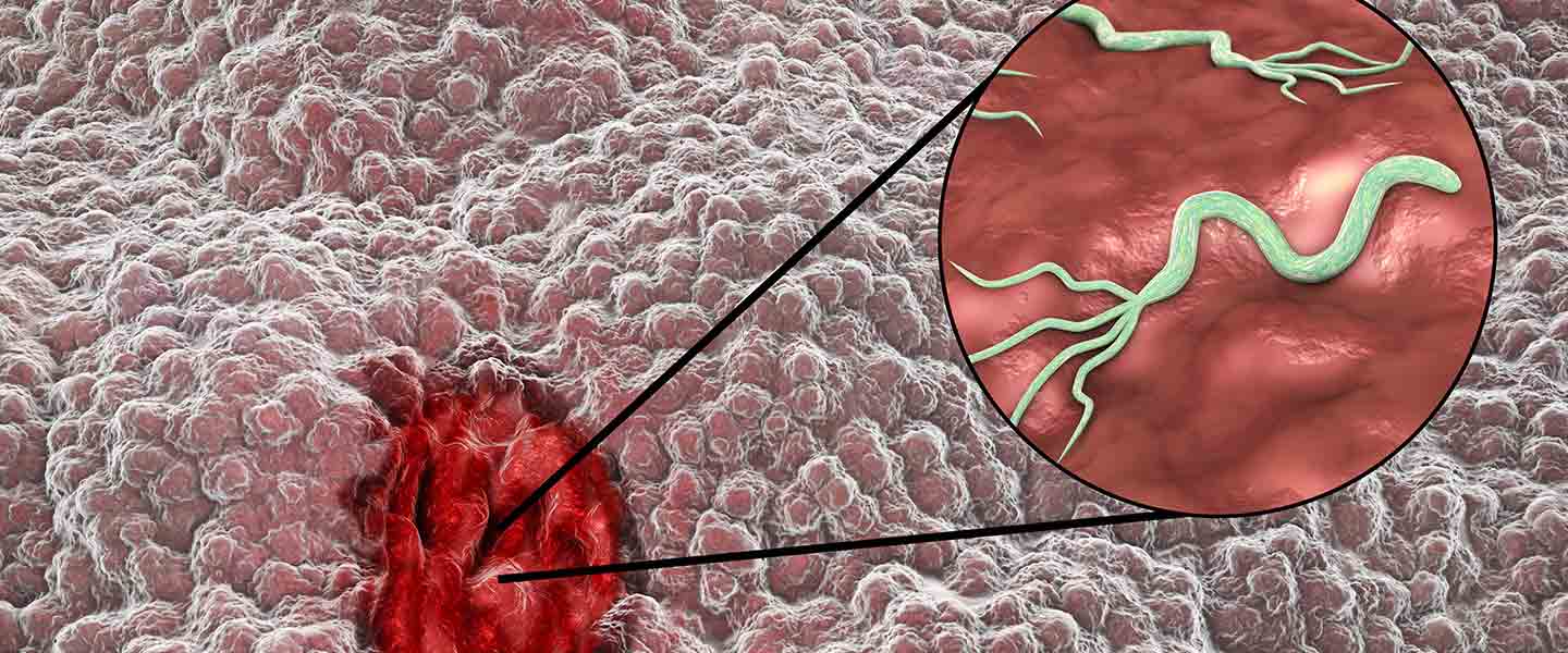 Ülser (Mide Yarası) Nedir? Ülsere Ne İyi Gelir ve Belirtileri Nelerdir?